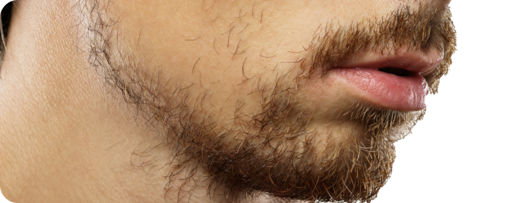 Implante barba - Clínica Espronceda